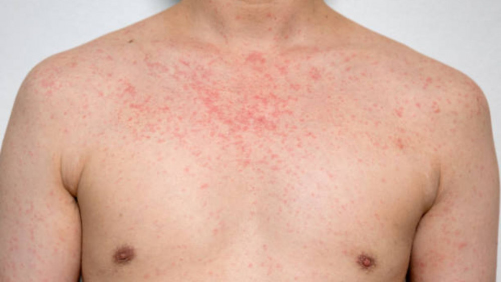 Lepkehimlő - Gyermekgyógyászat